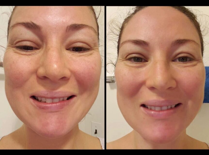 How Face Yoga and Facial Exercises Can Help With Bell's Palsy