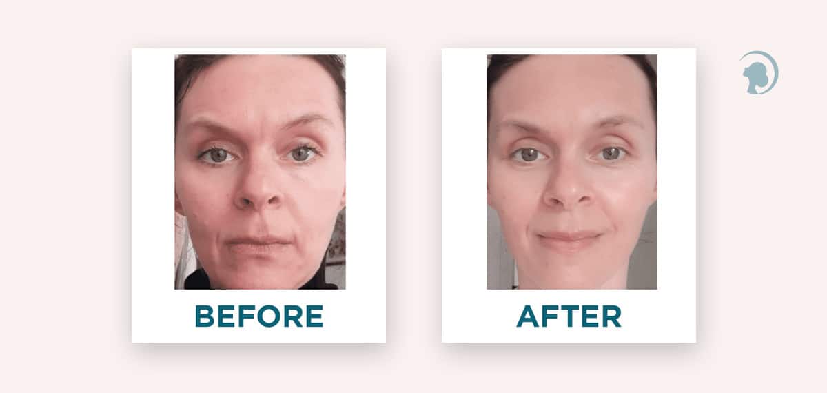 10 Astonishing Before And After Face Yoga Transformations