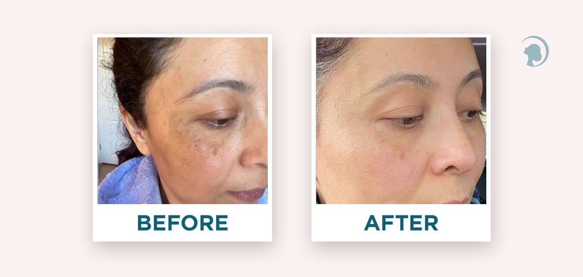 10 Astonishing Before And After Face Yoga Transformations